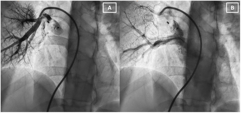 Closure of nontraumatic complex arteriovenous fistula | Revista ...