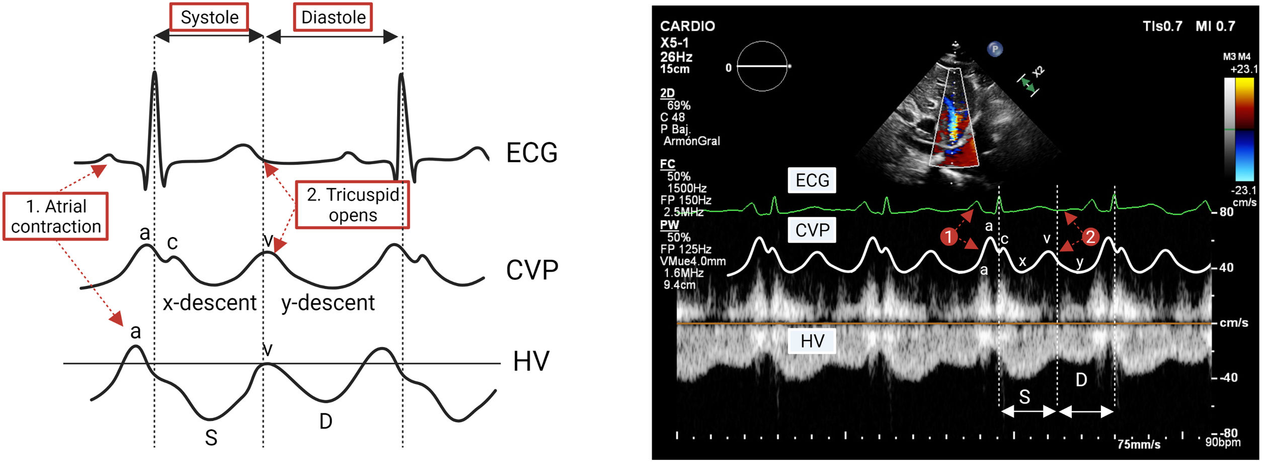 Assessment of filling pressures and fluid overload in heart failure: an ...