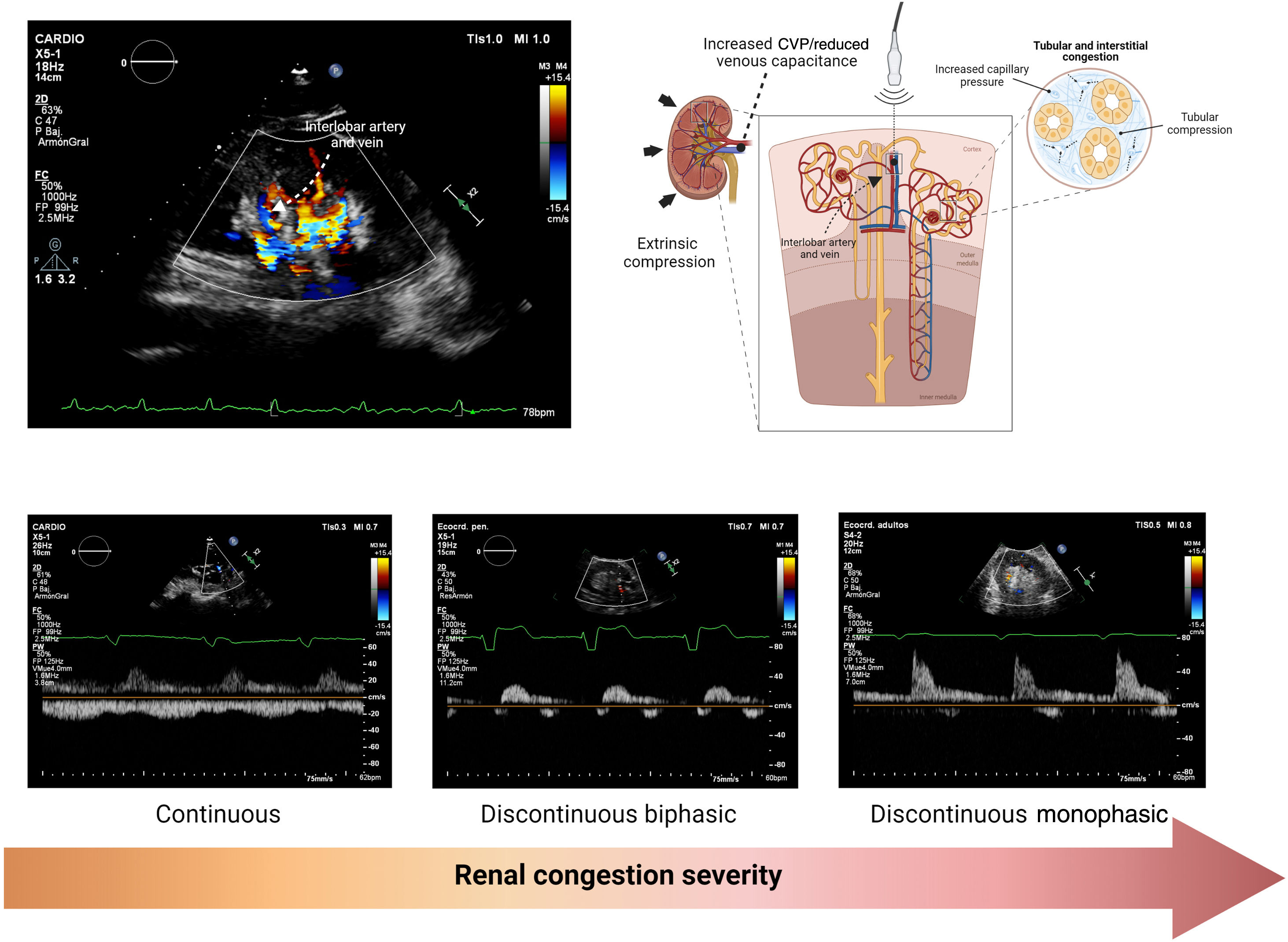 Assessment of filling pressures and fluid overload in heart failure: an ...