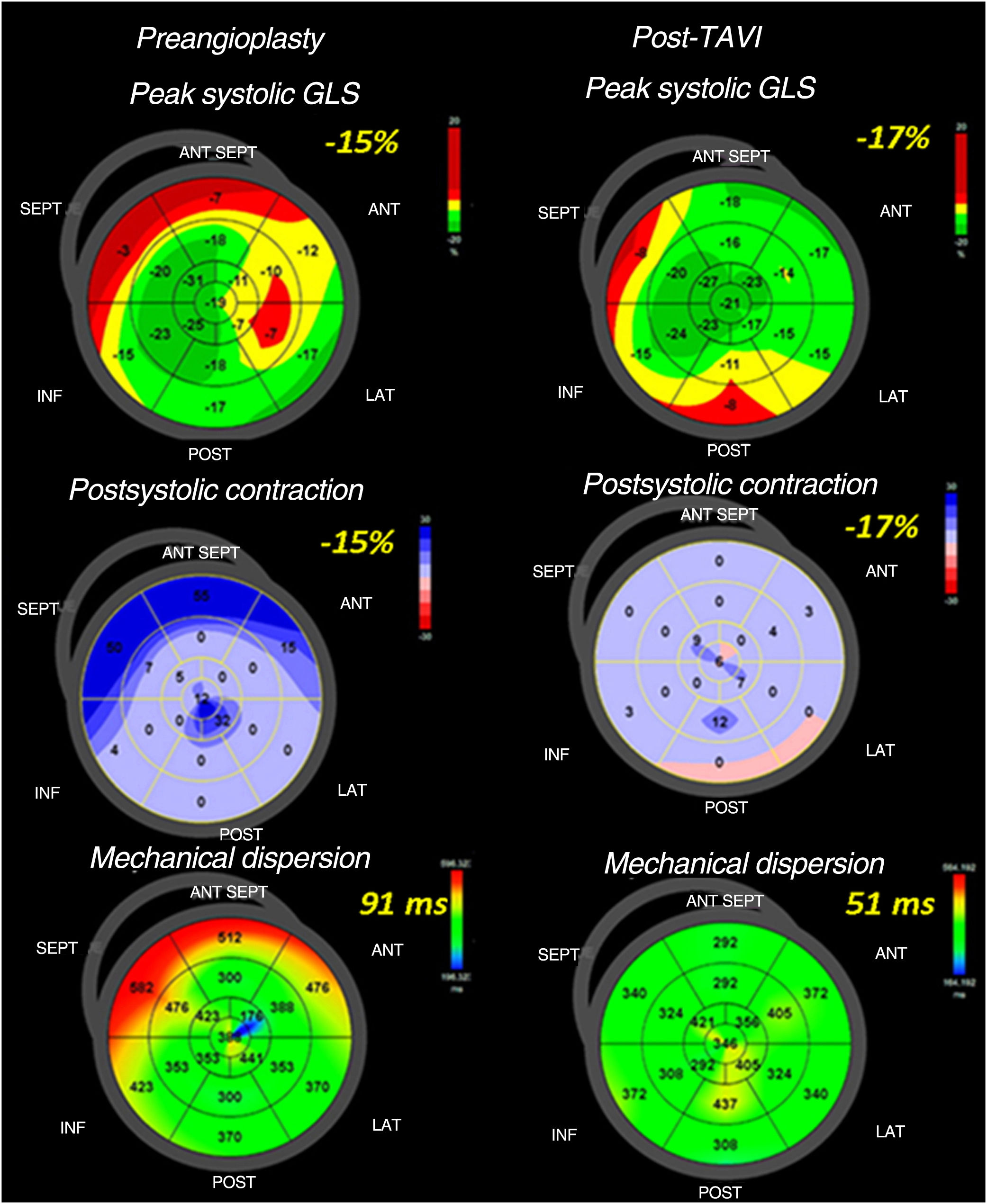 Pre- and post-TAVI myocardial work in the critically-ill patient ...