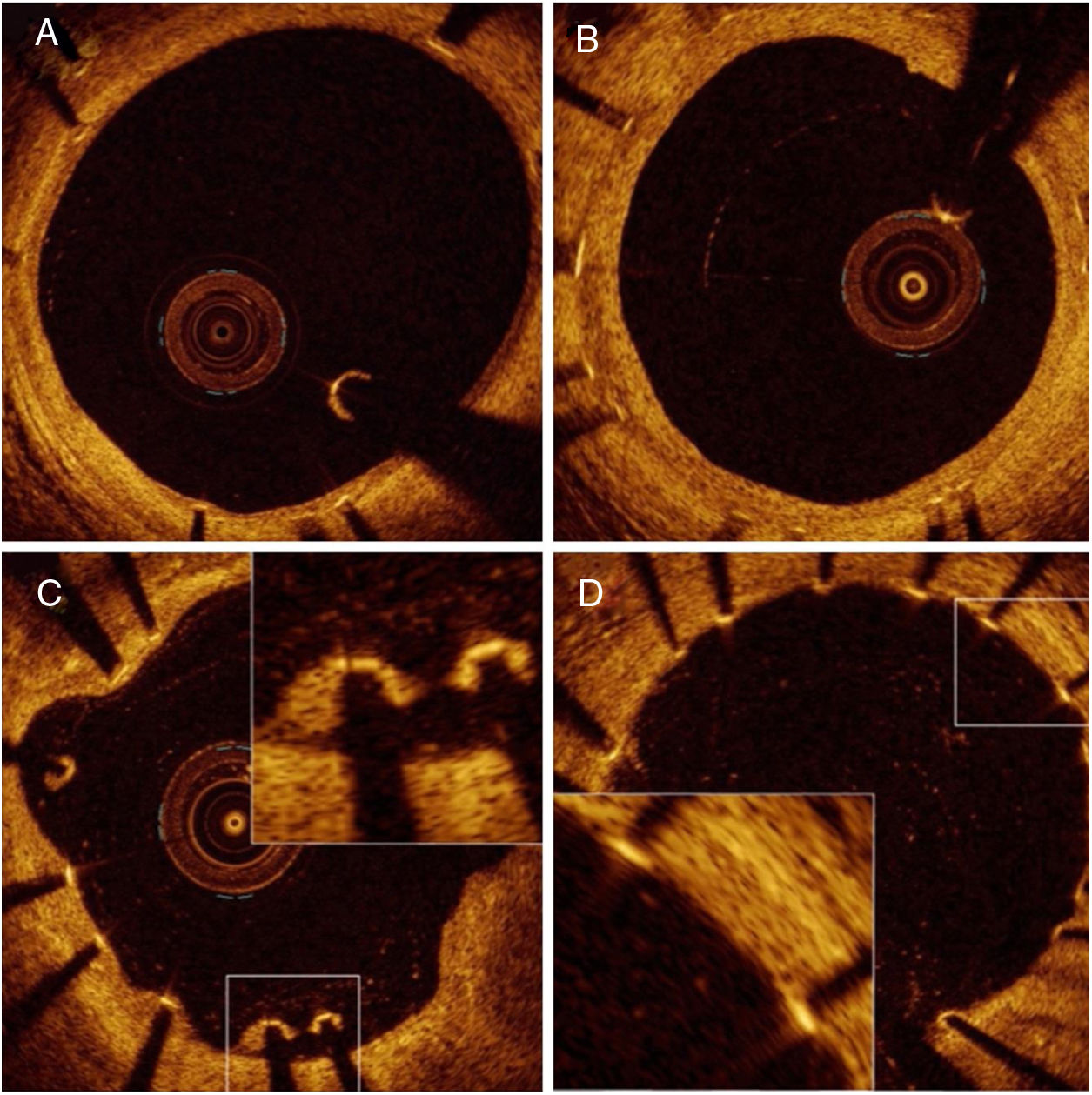Comparative study of neointimal coverage between titanium-nitric oxide ...