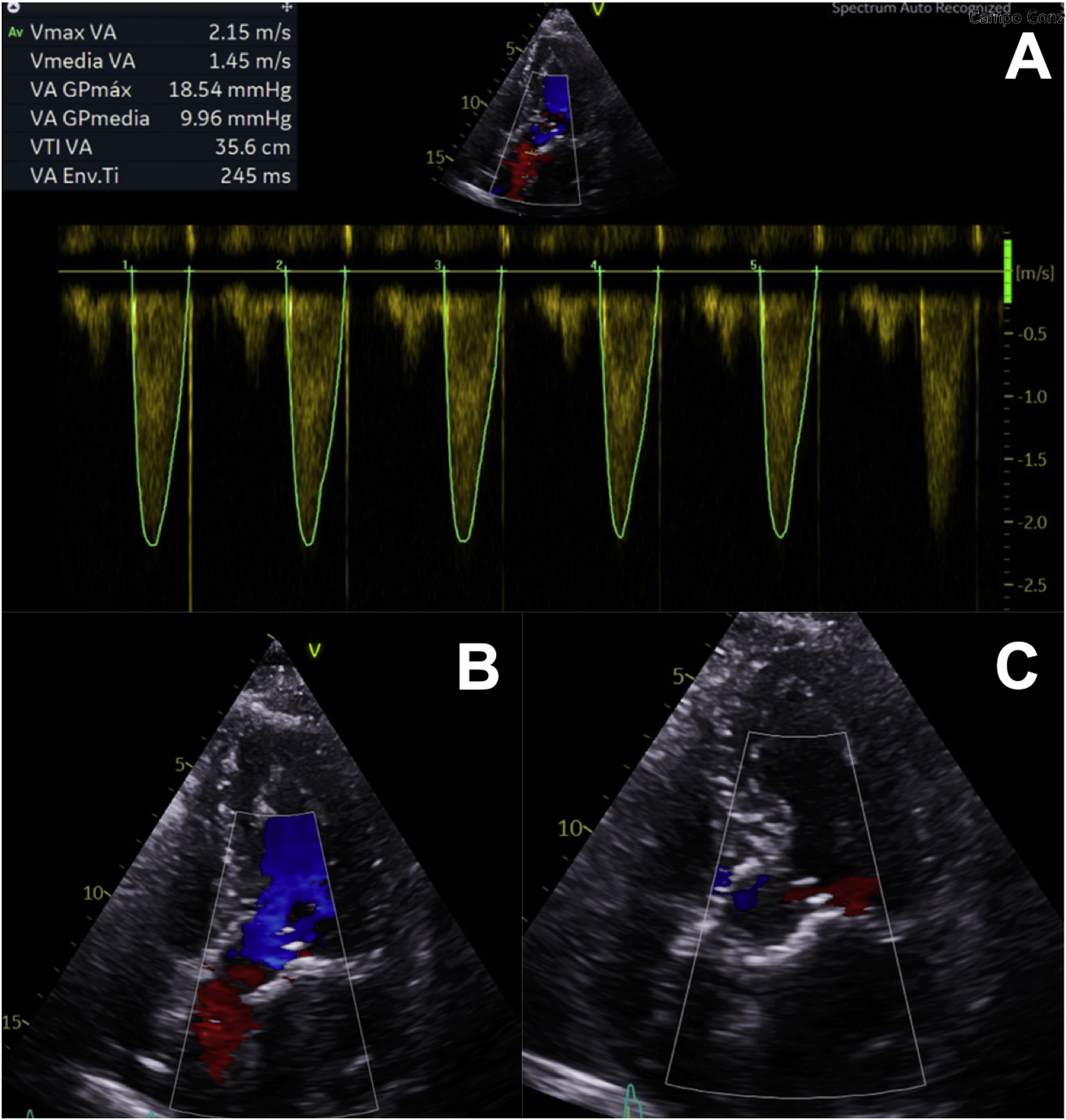 Transcatheter aortic valve implantation with the self-expandable and ...