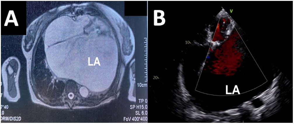 Giant left atrium in previous mitral valve repair | Revista Española de ...