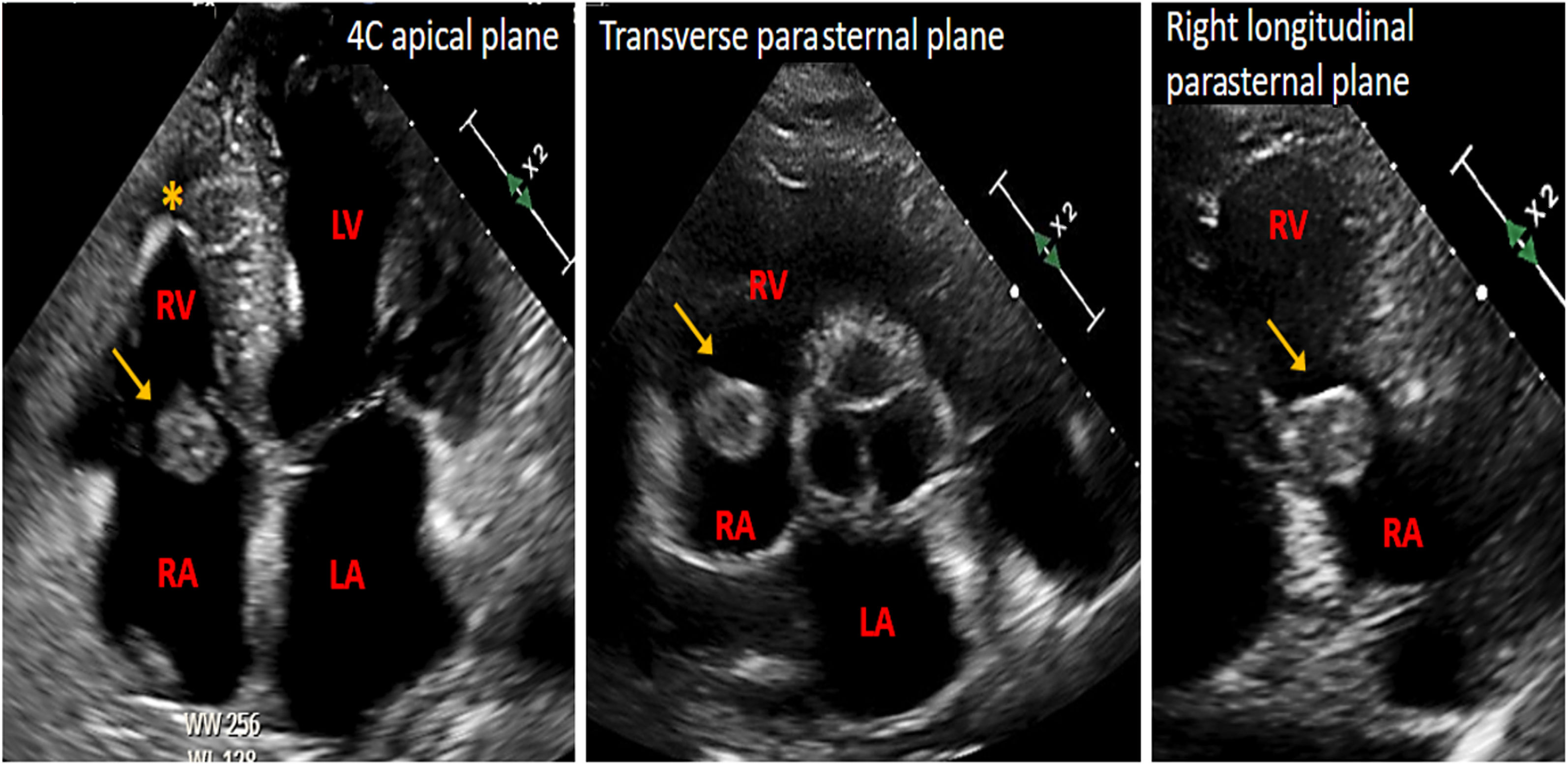 Multimodality imaging in caseous necrosis of tricuspid annulus ...