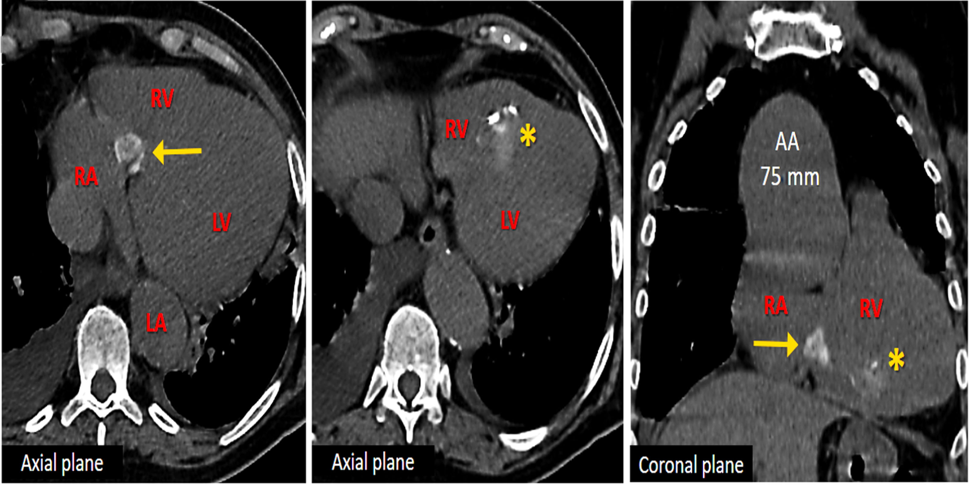 Multimodality imaging in caseous necrosis of tricuspid annulus ...