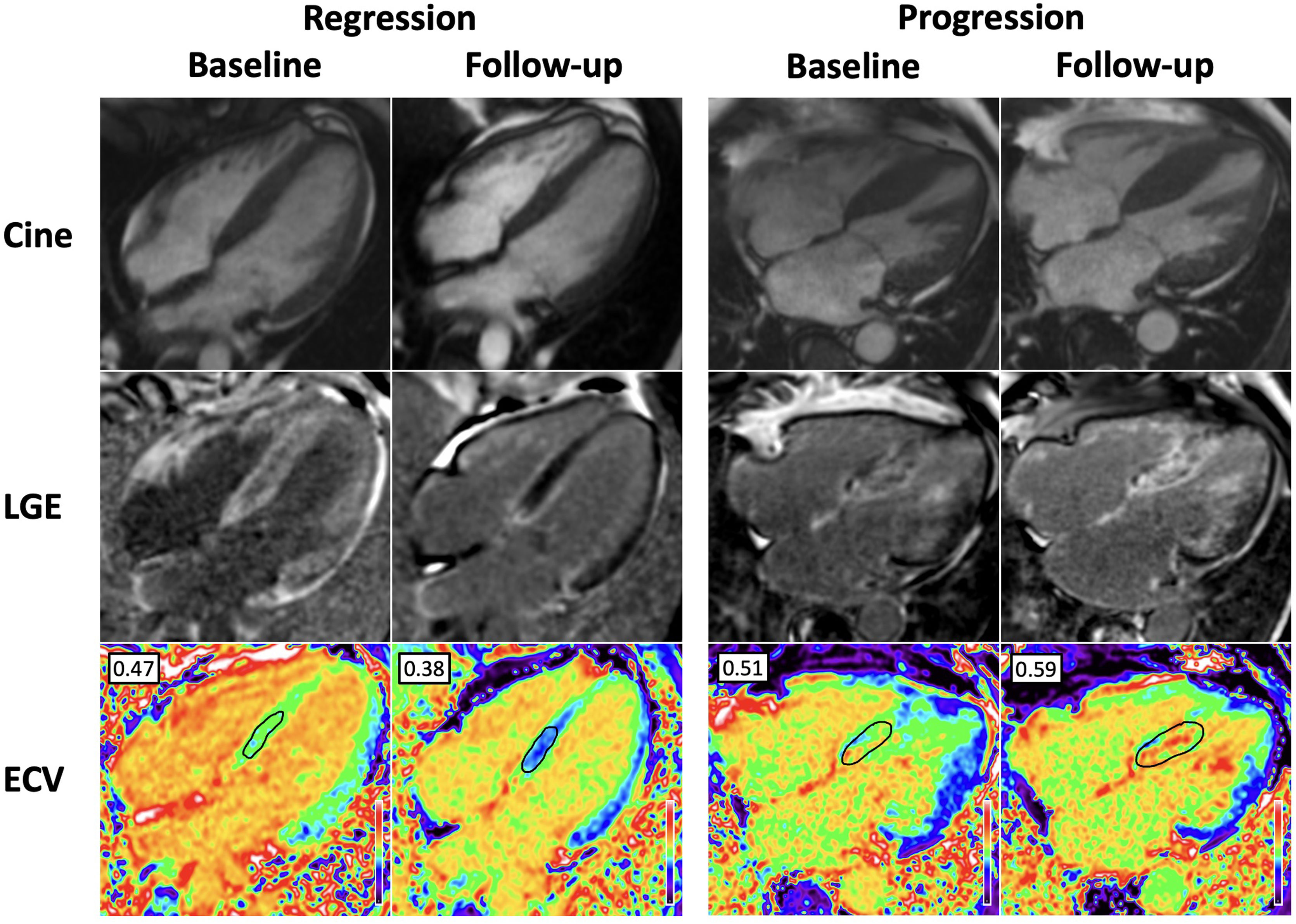 Monitoring cardiac amyloidosis with multimodality imaging | Revista ...