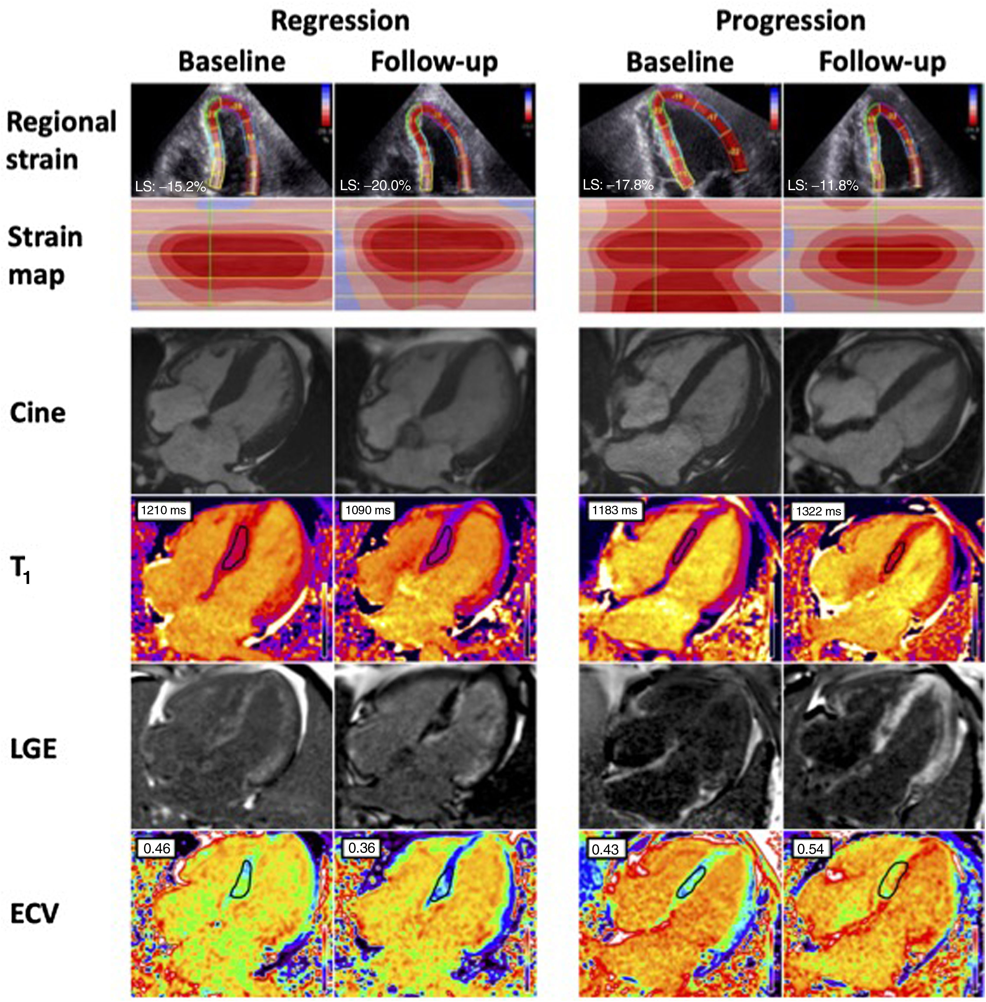 Monitoring cardiac amyloidosis with multimodality imaging - Revista ...
