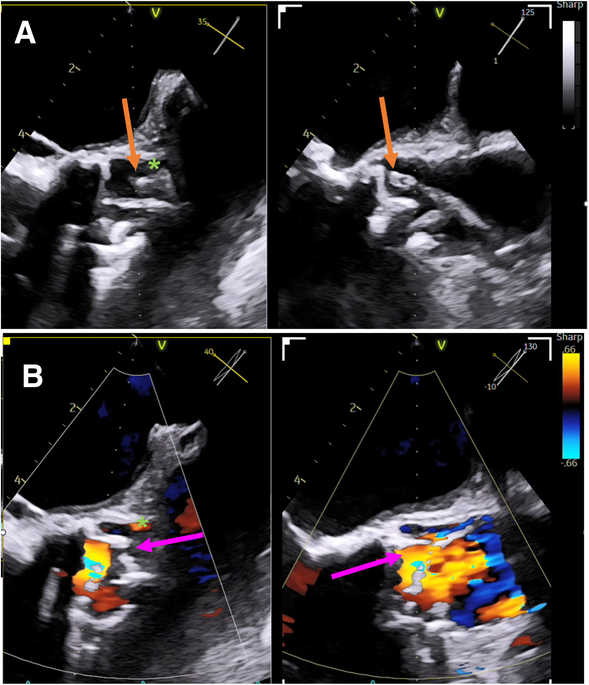 Safety and efficacy of the BASILICA technique in patients at high risk ...