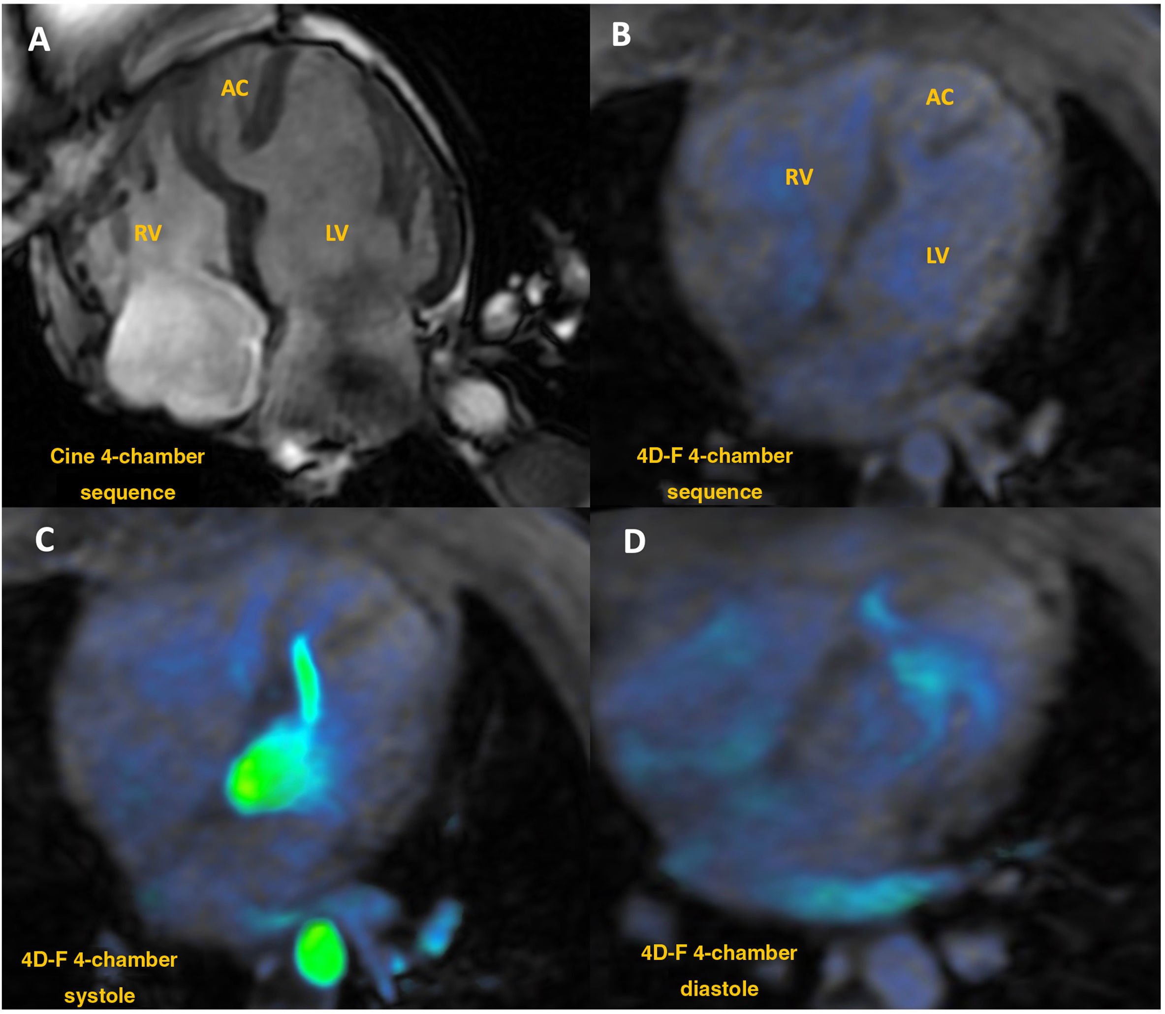 4D-flow CMR assessment: a key tool in corrected congenital heart ...