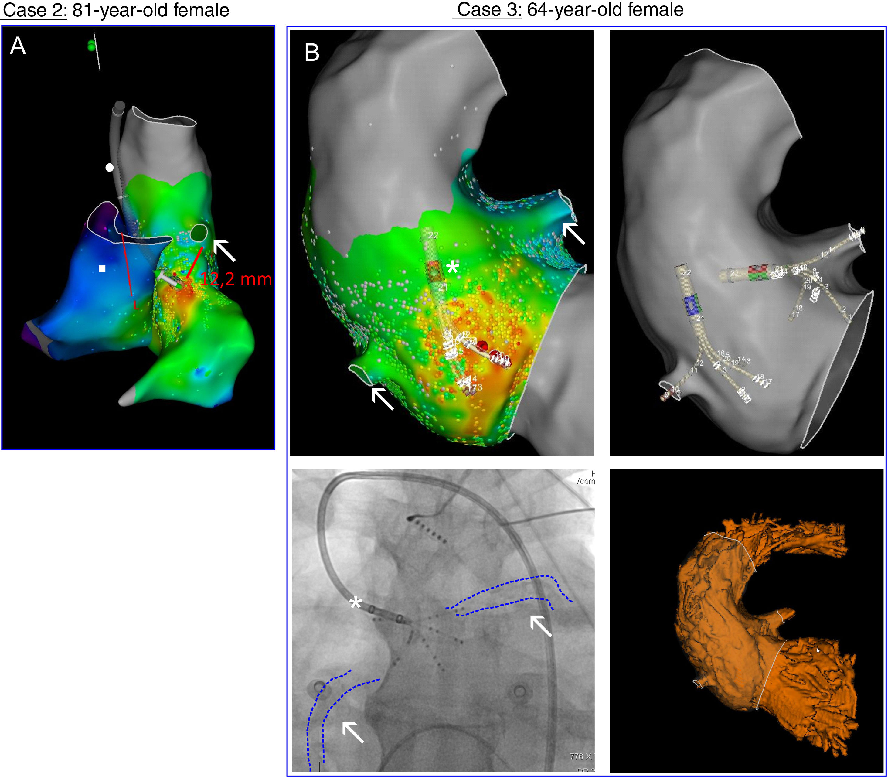 PentaRay floppy splines for coronary artery ostia location | Revista ...