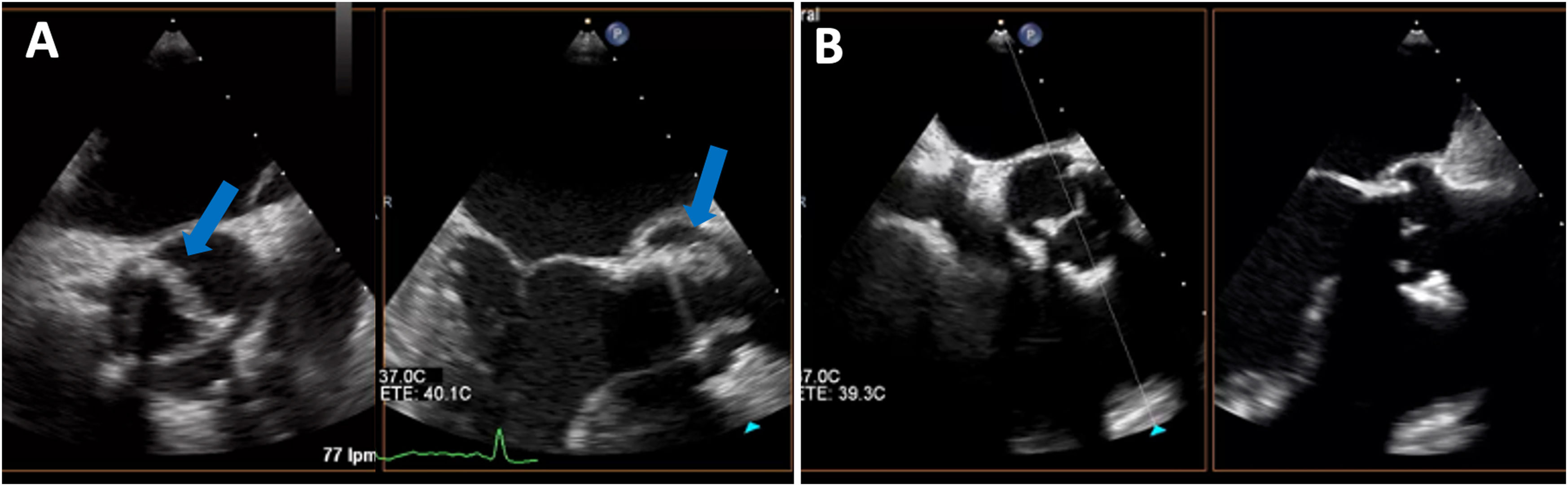 infective endocarditis echo features