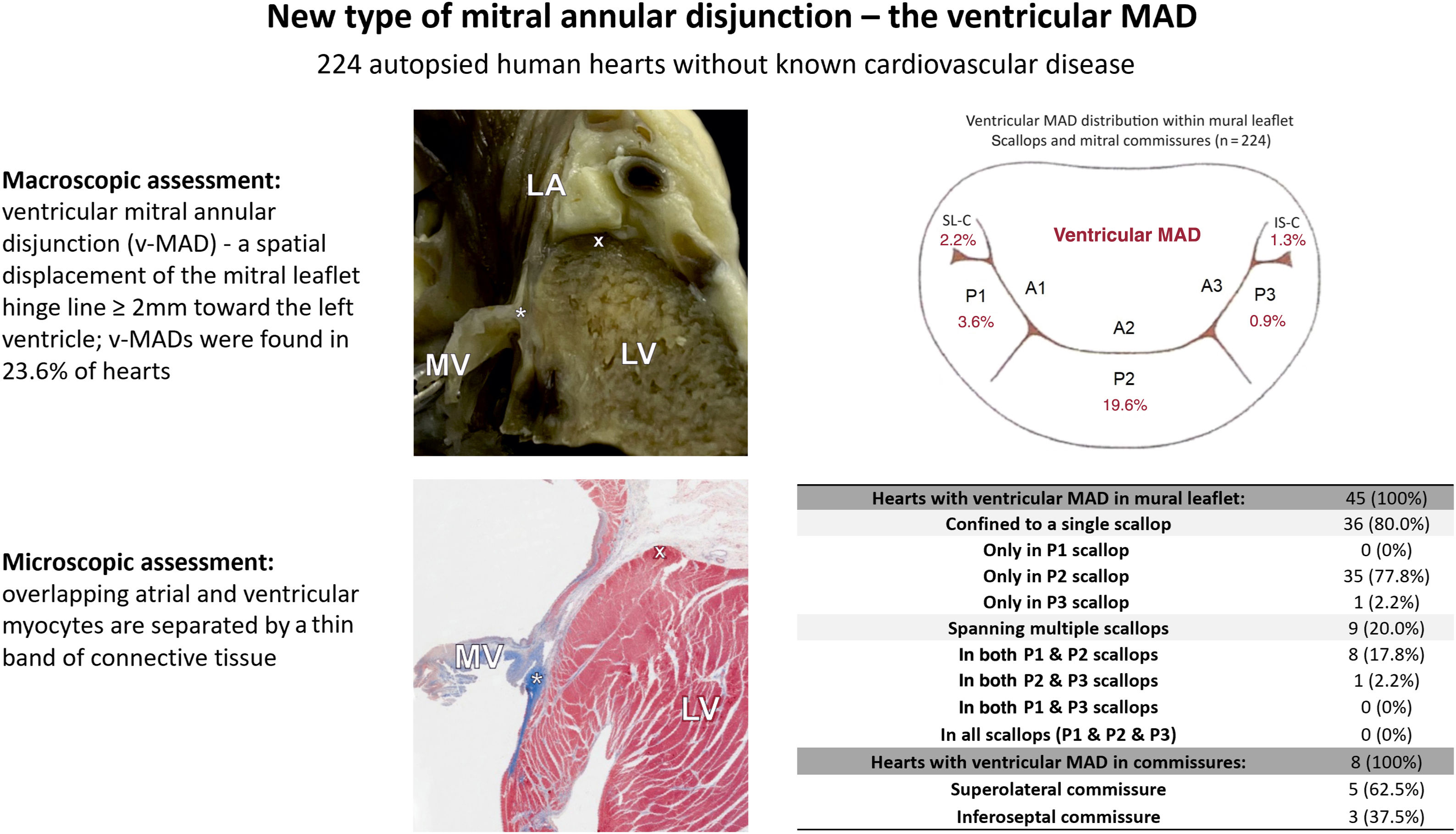 Description and prevalence of ventricular mitral annular disjunction ...