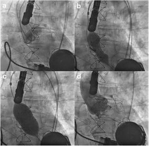 The novel balloon-expandable Myval transcatheter heart valve ...
