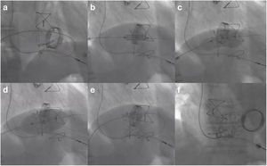 The novel balloon-expandable Myval transcatheter heart valve ...