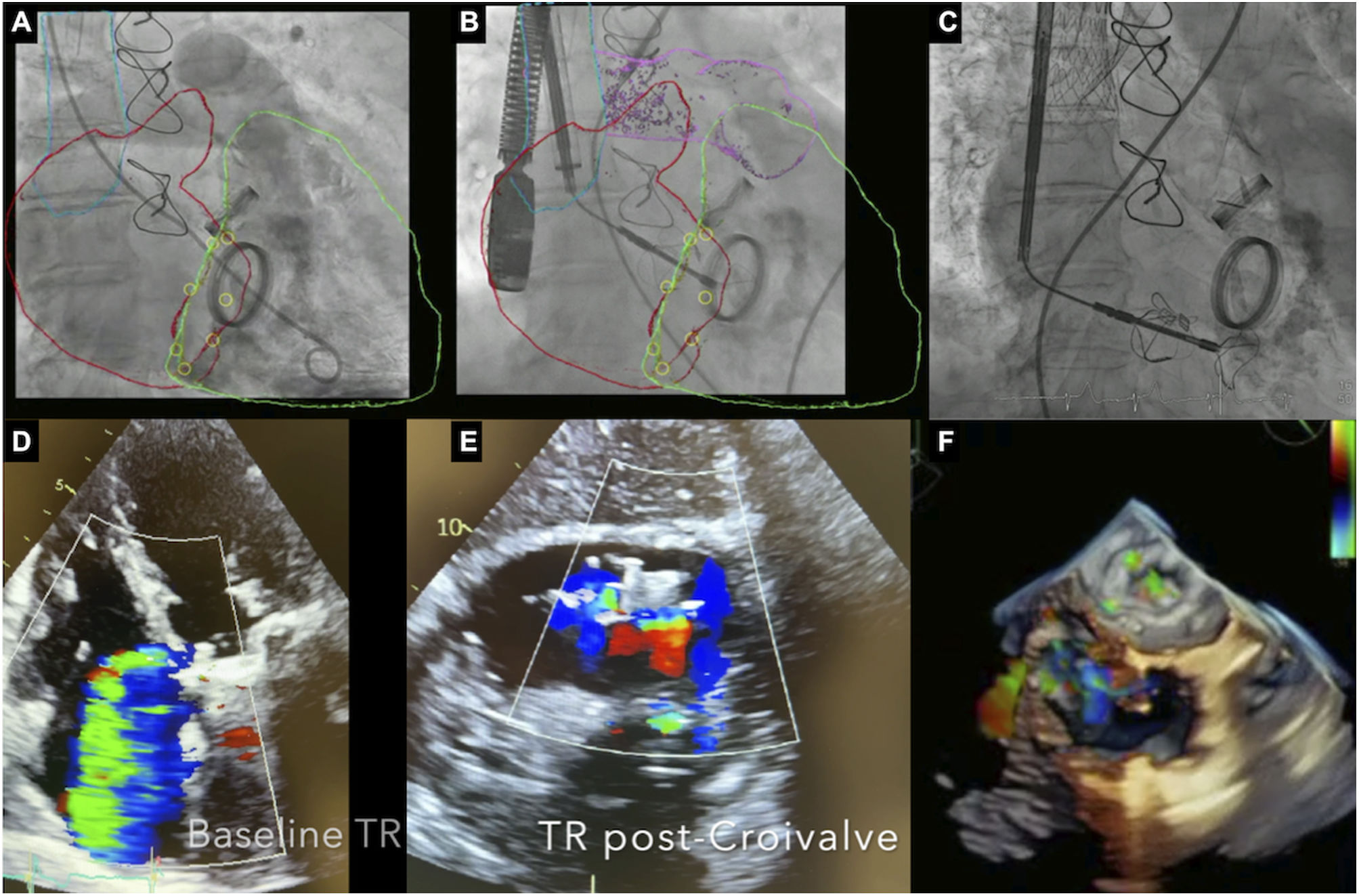Orthotopic transcatheter tricuspid coaptation valve system for severe ...