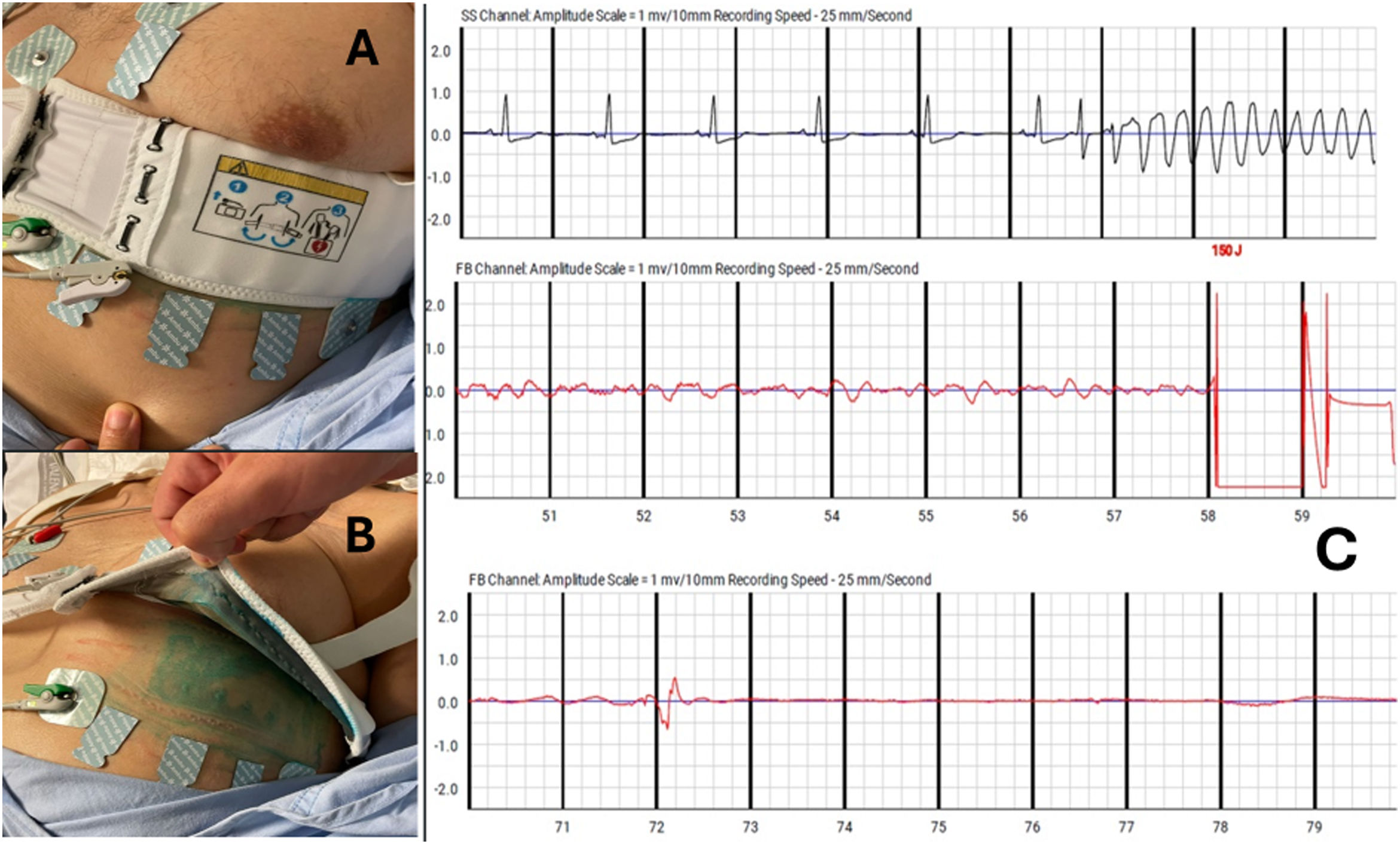 Importance of sudden cardiac death risk assessment: the wearable ...