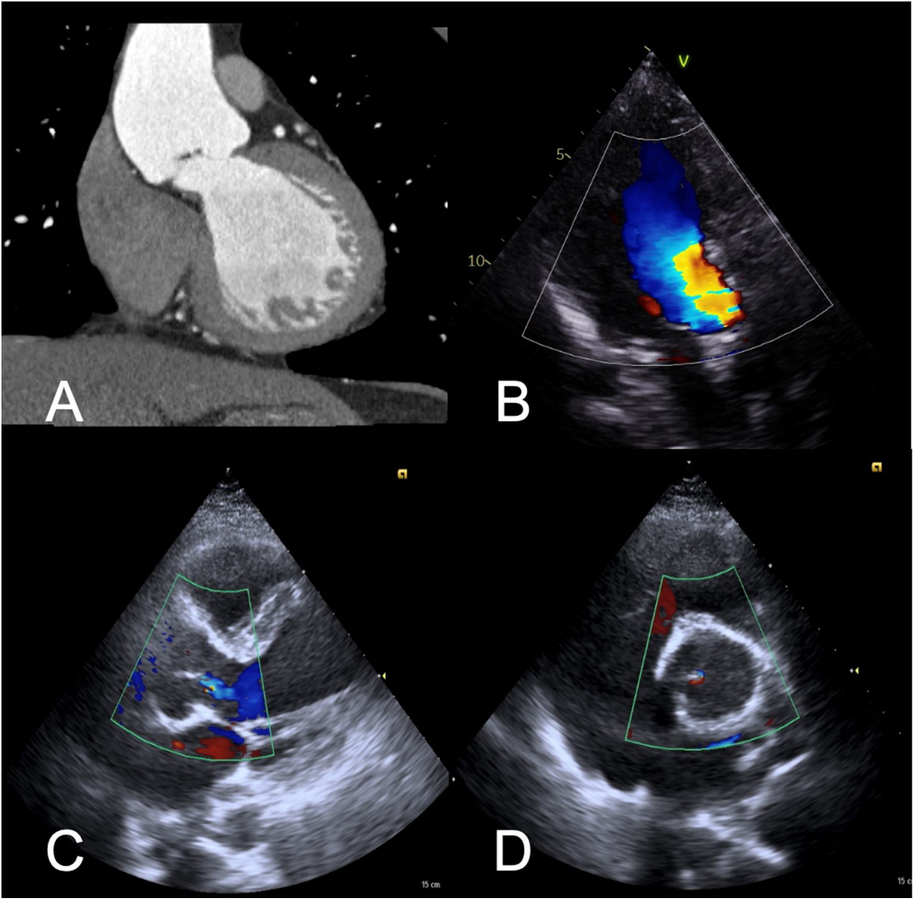 David after Ross: a possible option before Bentall? - Revista Española ...