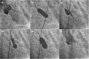 The novel balloon-expandable Myval transcatheter heart valve ...