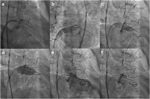 The novel balloon-expandable Myval transcatheter heart valve ...