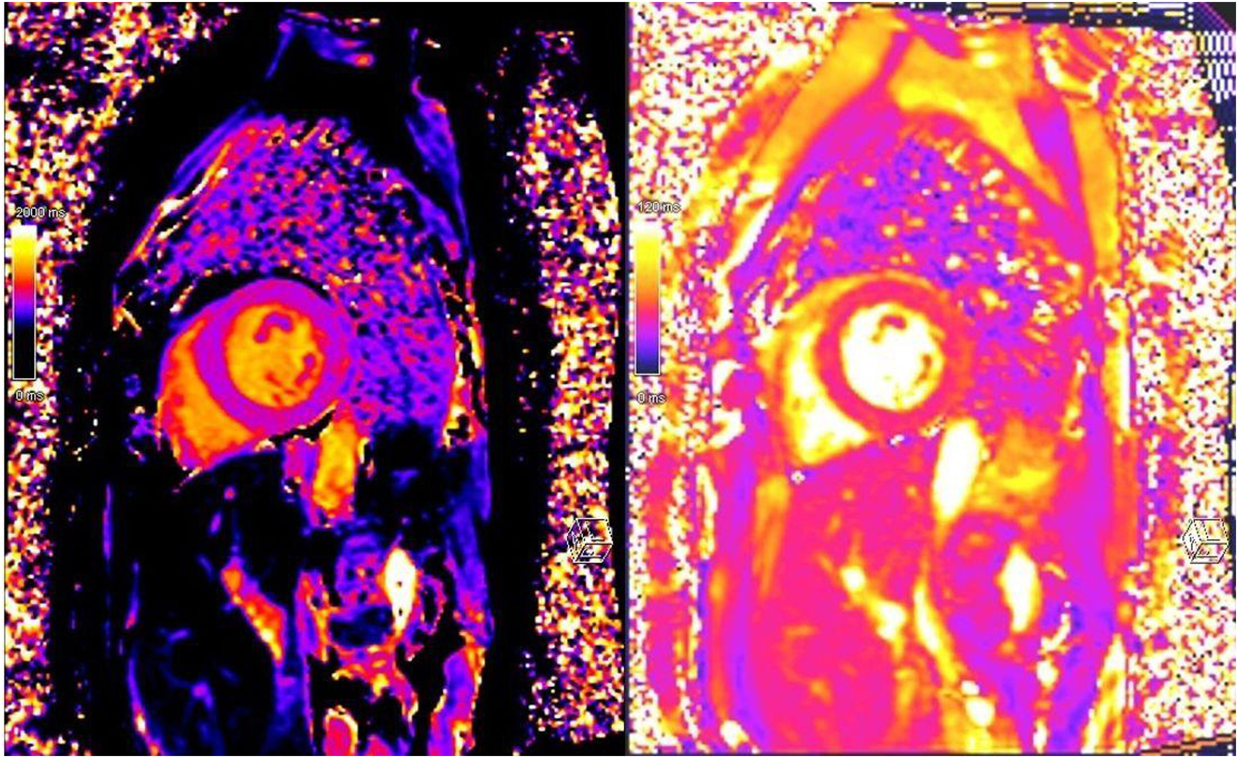 Myocarditis Secondary To Small Vessel Vasculitis An Uncommon Etiology