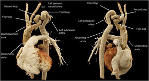 Corkscrew aortic arch. PHACES syndrome - Revista Española de ...