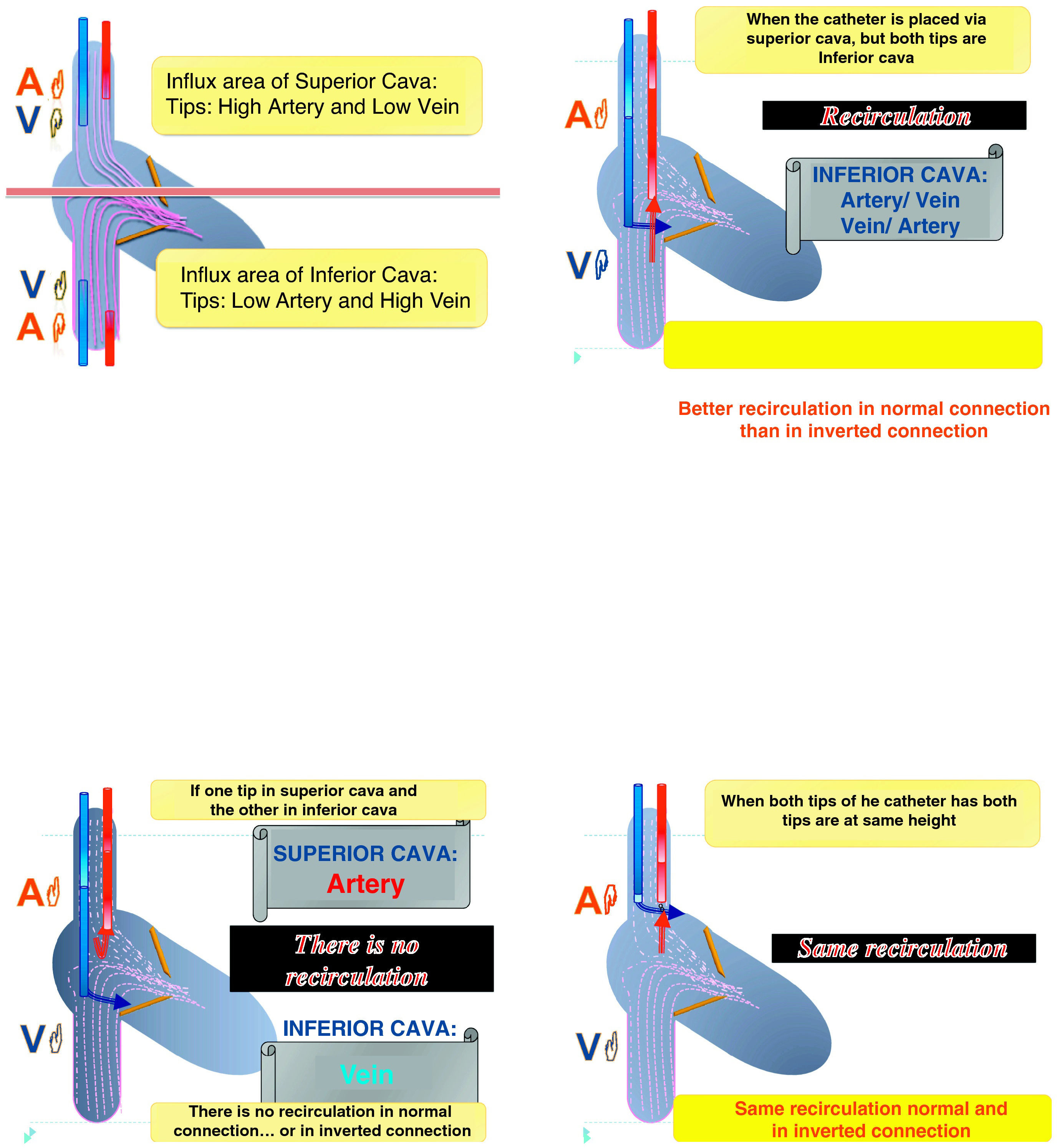 Vascular access for haemodialysis. Position of the tip of the vascular ...