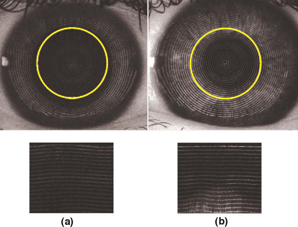 Tear Film Surface Quality with Soft Contact Lenses Using Dynamic ...