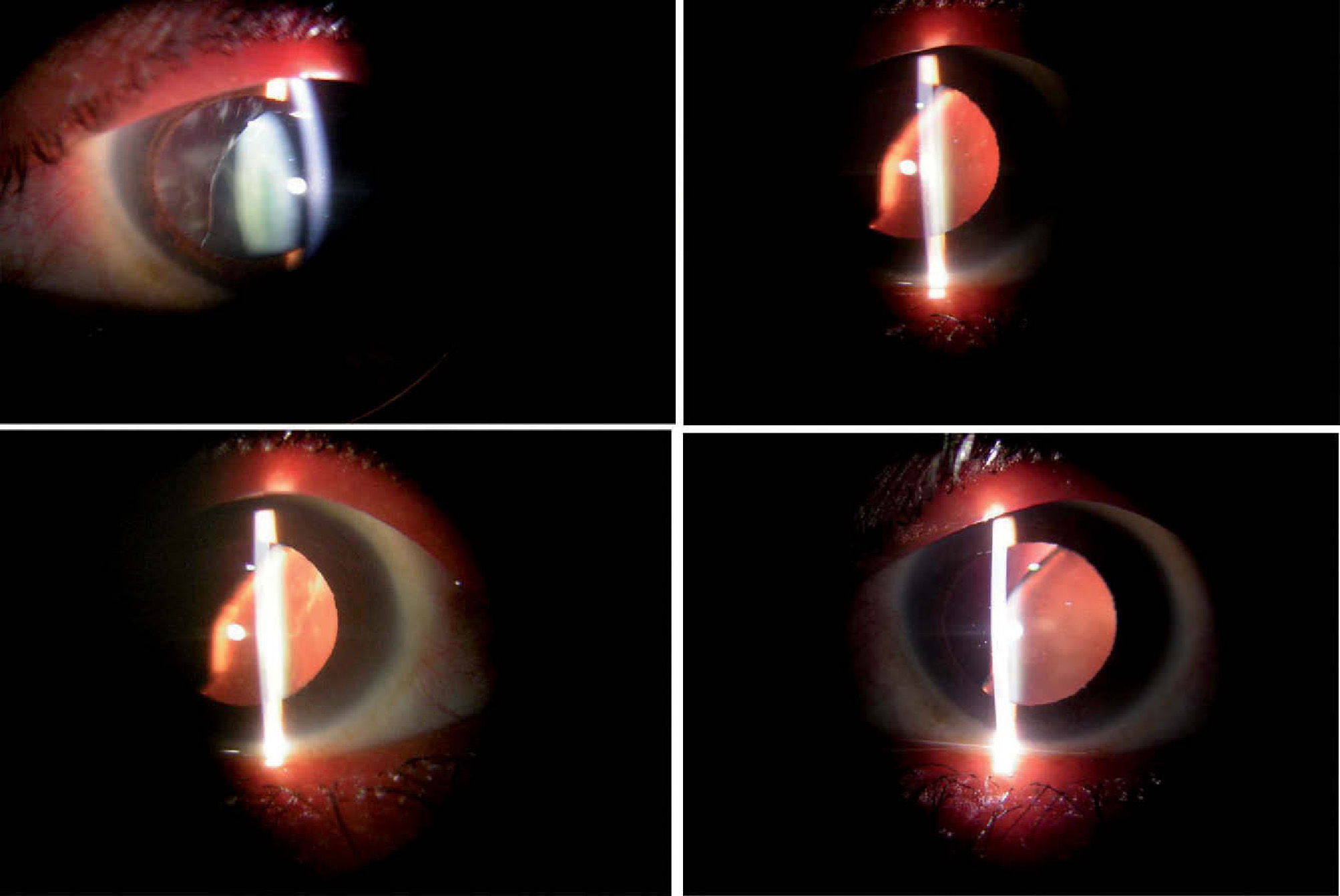 Superior Lens Coloboma with Superior Rectus Palsy and Congenital Ptosis ...