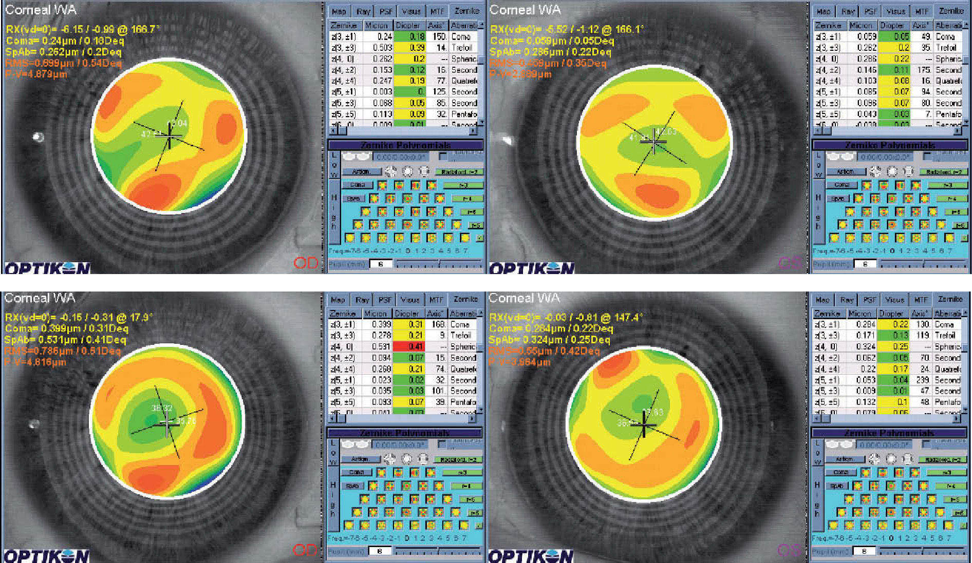 Bilateral Symmetry before and Six Months after Aberration-Free ...