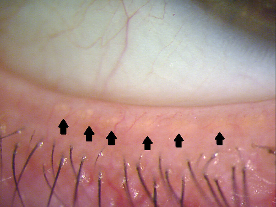 meibomian gland observation