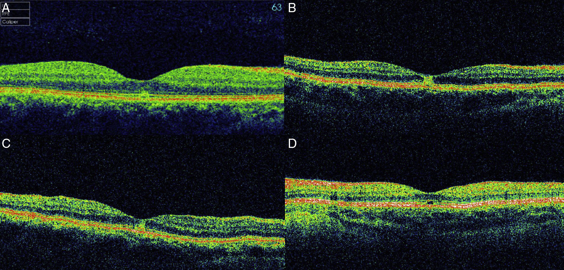 Acute eclipse retinopathy: A small case series | Journal of Optometry