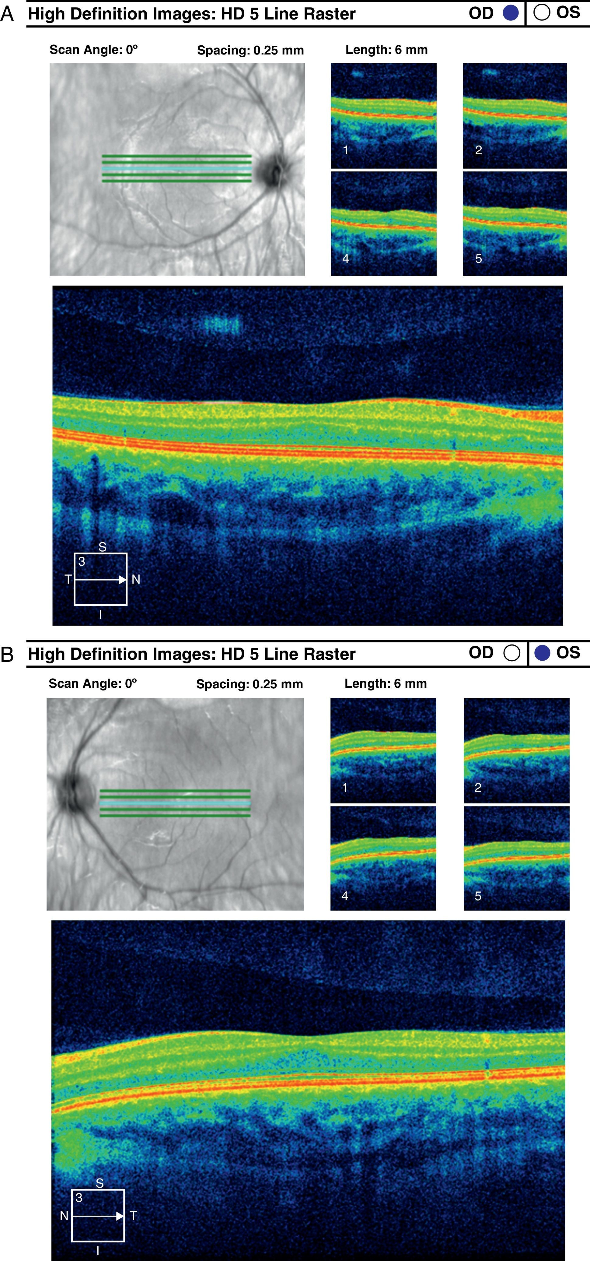 Macular pigment optical density spatial distribution measured in a ...