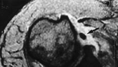 Rotura completa aislada del tendón del subescapular | Revista Española ...