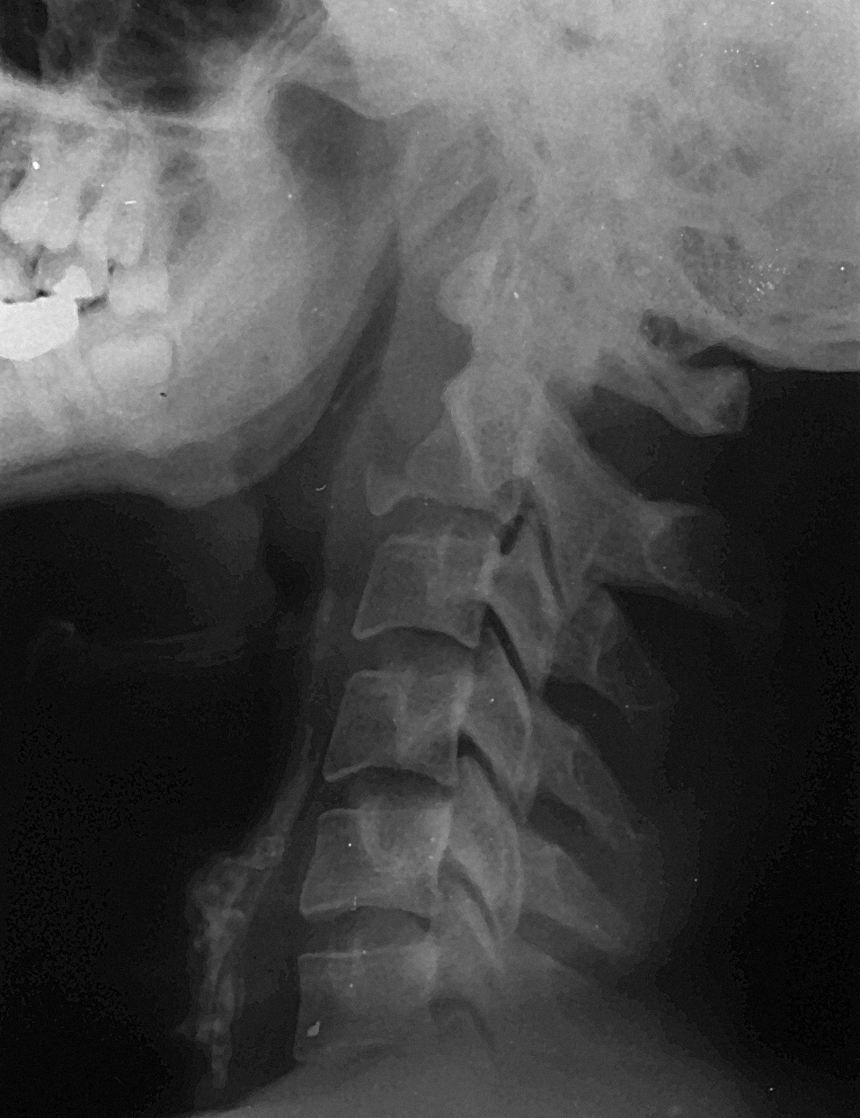 Fracturas Del Axis Revista Espa ola De Cirug a Ortop dica Y Traumatolog a Fracturas Del Axis Revista Espa ola De Cirug a Ortop dica Y Traumatolog a