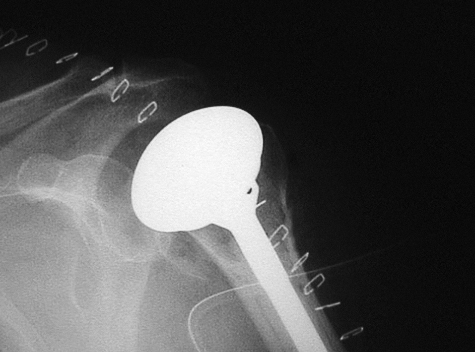 Influencia de la versión protésica y de la consolidación del troquíter ...