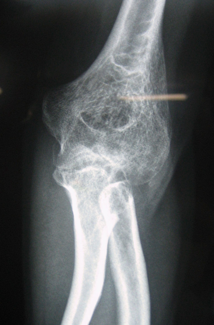 Rigidez de codo postraumática | Revista Española de Cirugía Ortopédica ...