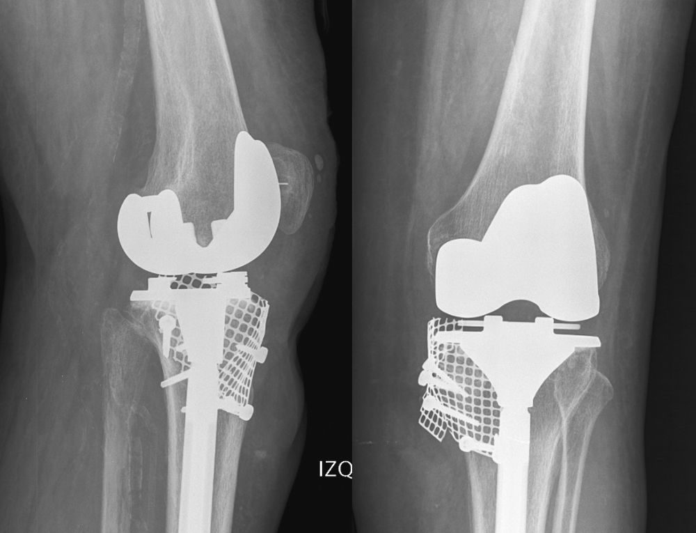 Fractura de platillo tibial interno tras artroplastia unicompartimental ...