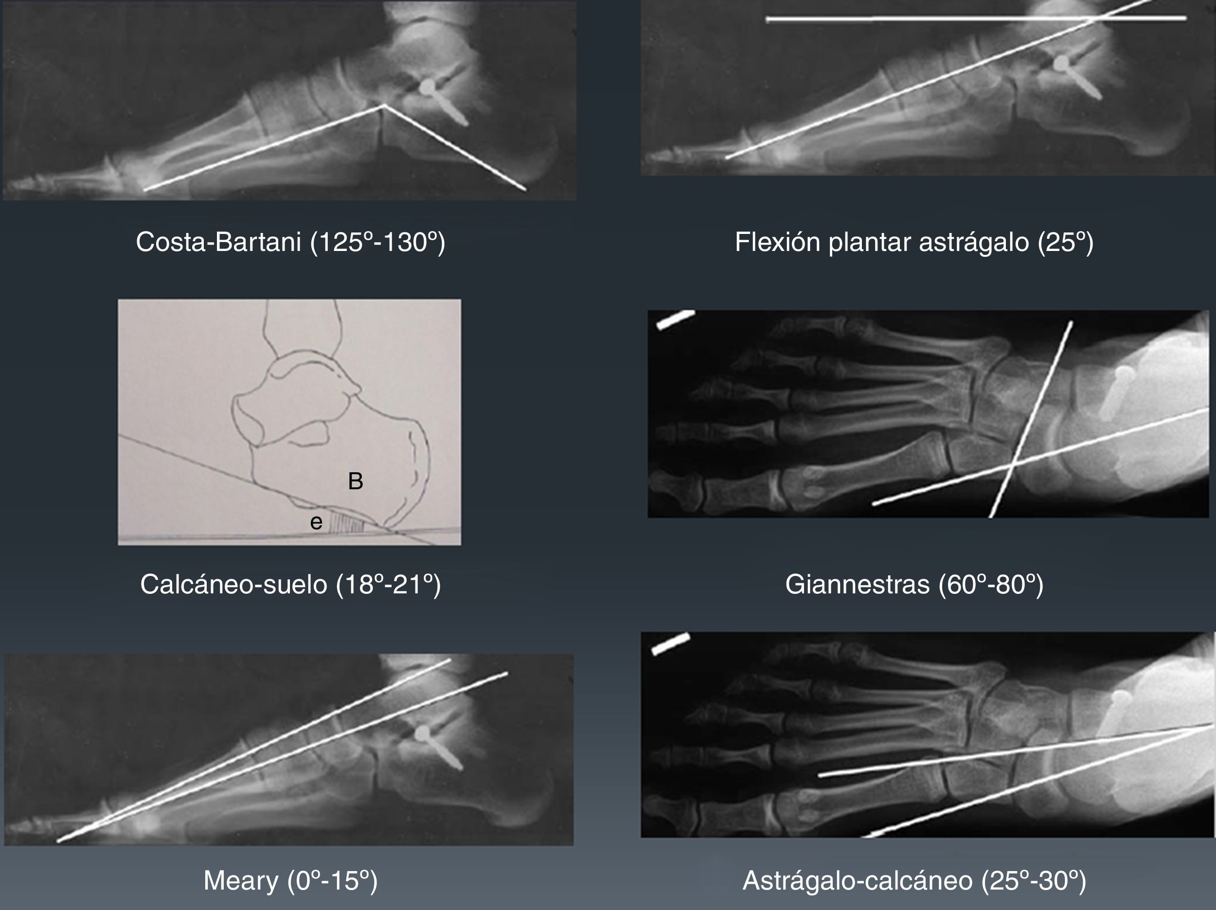 Más de 10 años de seguimiento de la técnica de calcáneo stop | Revista ...