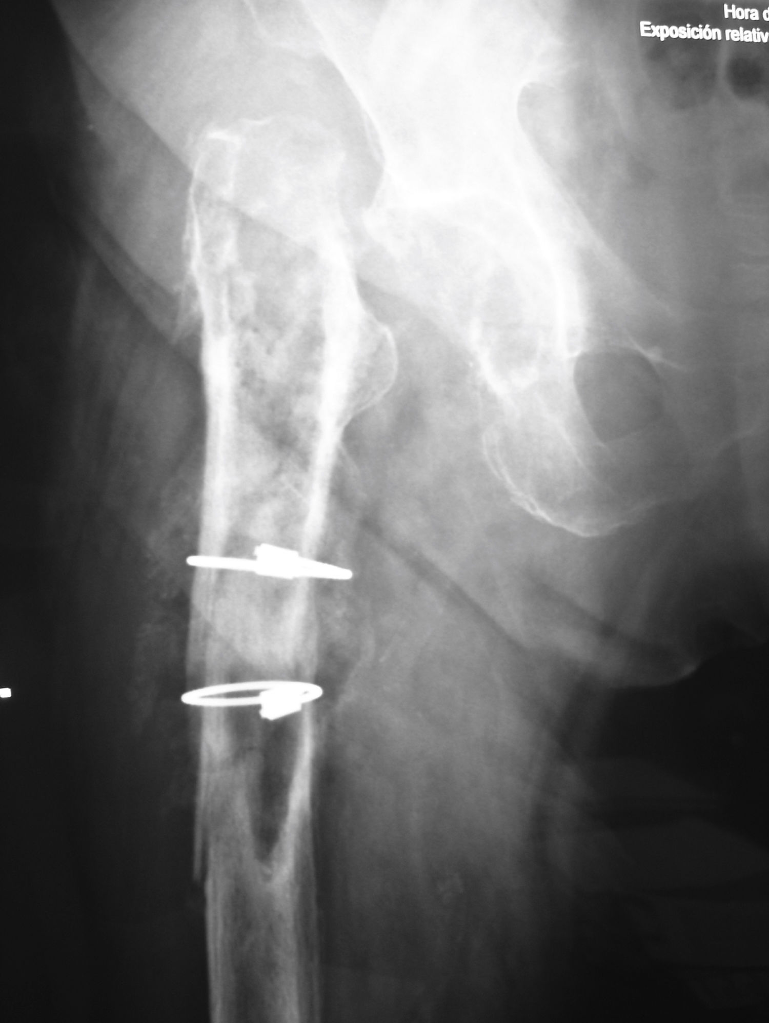 Calidad de vida tras artroplastia resección de Girdlestone | Revista ...