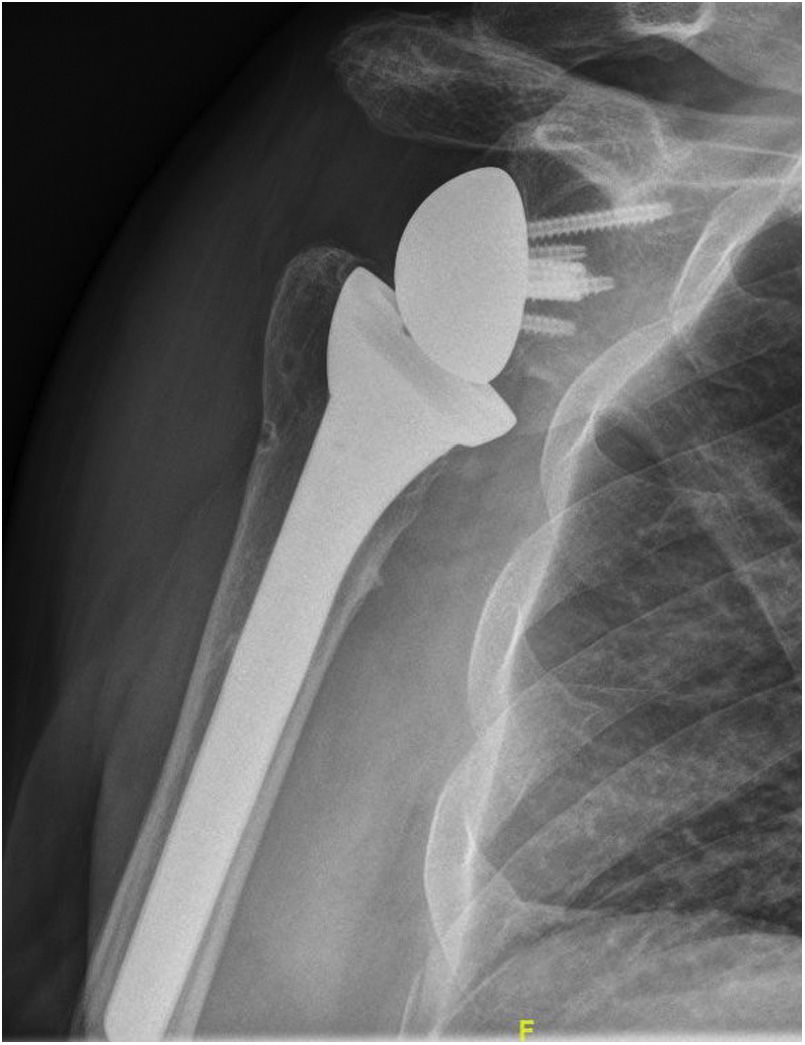 [Translated article] Scapular notching in reverse shoulder arthroplasty ...