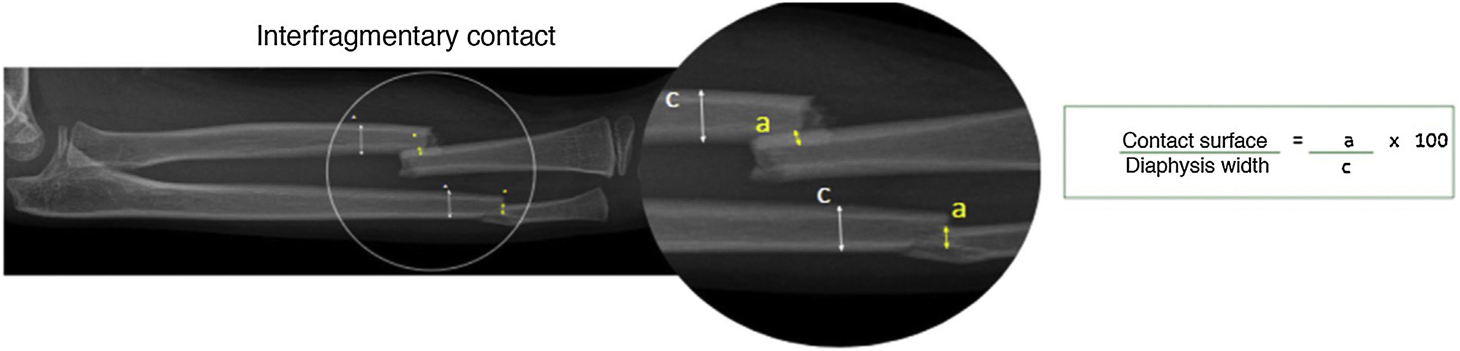 Radius shortening as a limiting factor for closed reduction in ...