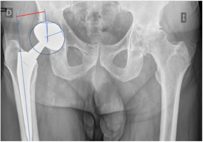 [Translated article] Comparison of the correction of the femoral offset ...