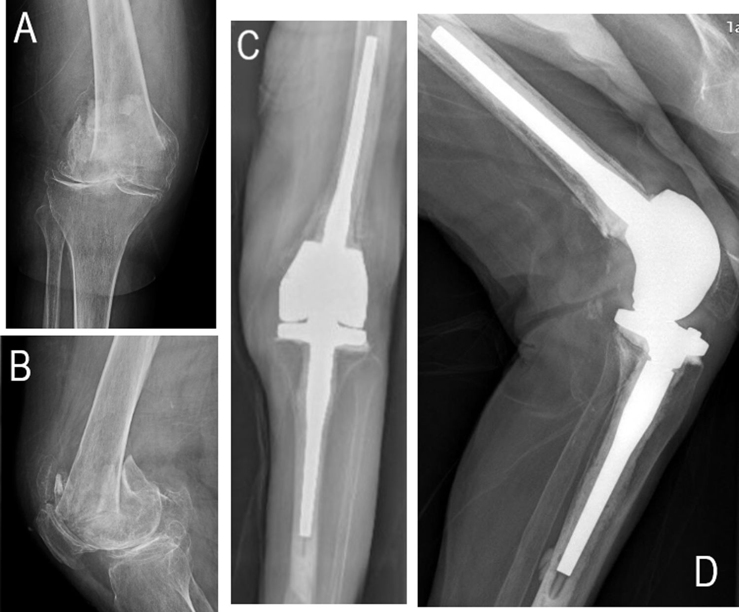 Complex distal femoral fractures in the fragile elderly patient treated ...
