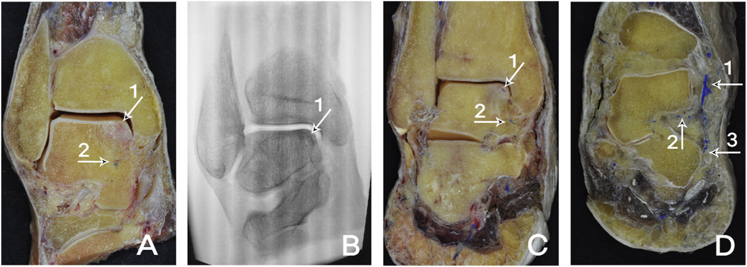 [Translated article] Graphic representation of intraosseous and ...