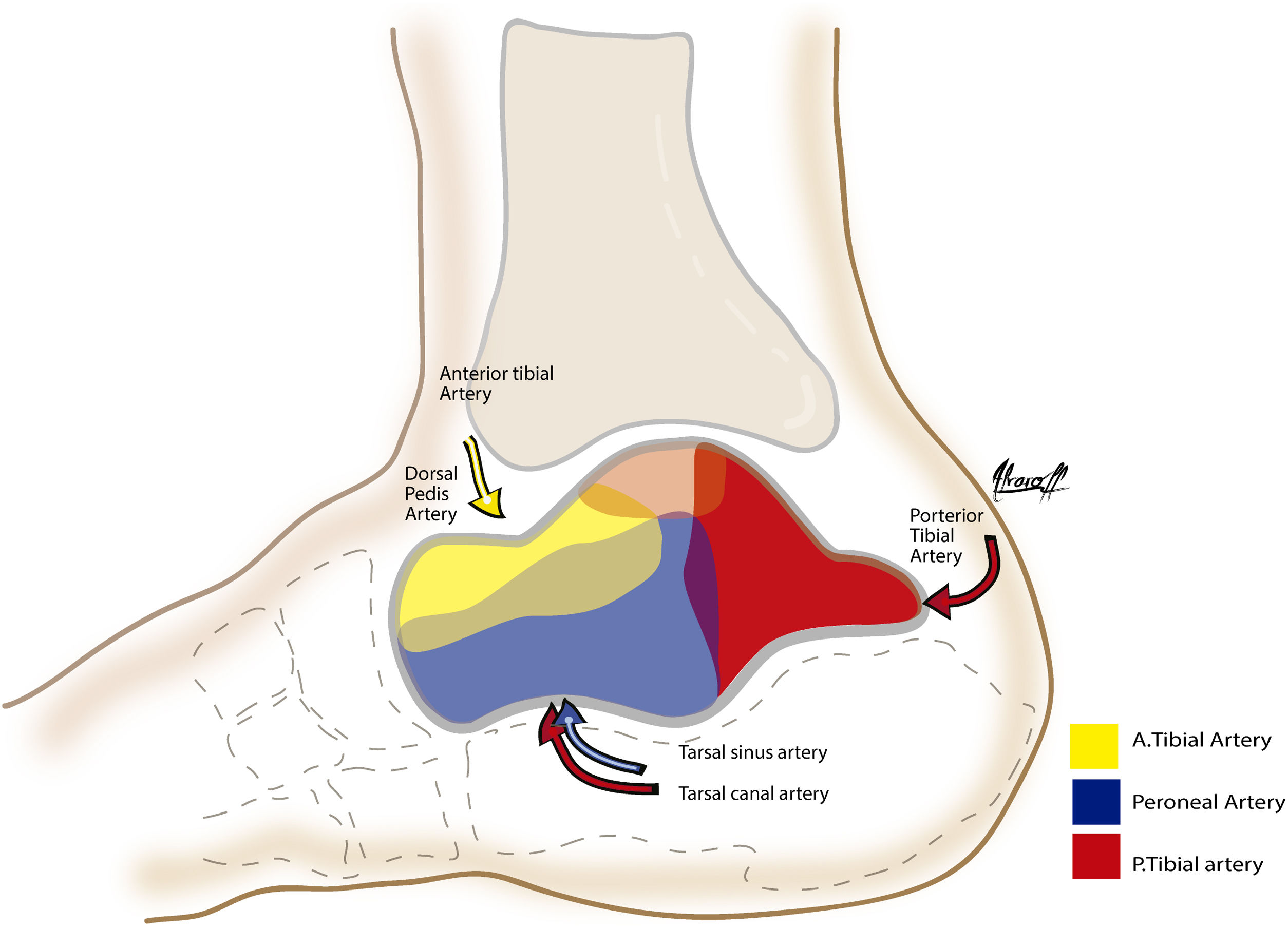 [Translated article] Graphic representation of intraosseous and ...