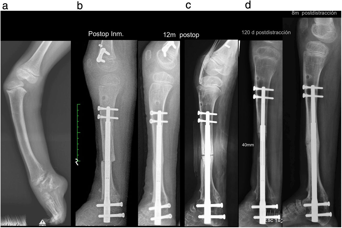 [Translated article] Bone lengthening with magnetic nails. Experience ...