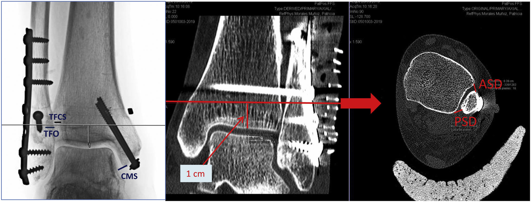 [Translated article] A randomised clinical trial comparing screws and ...