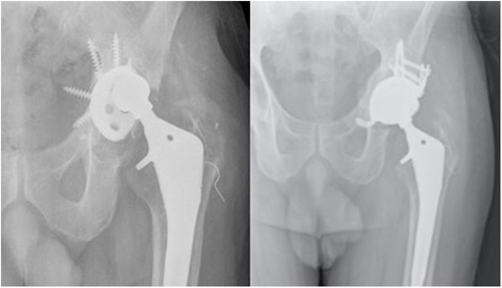 acetabular defect