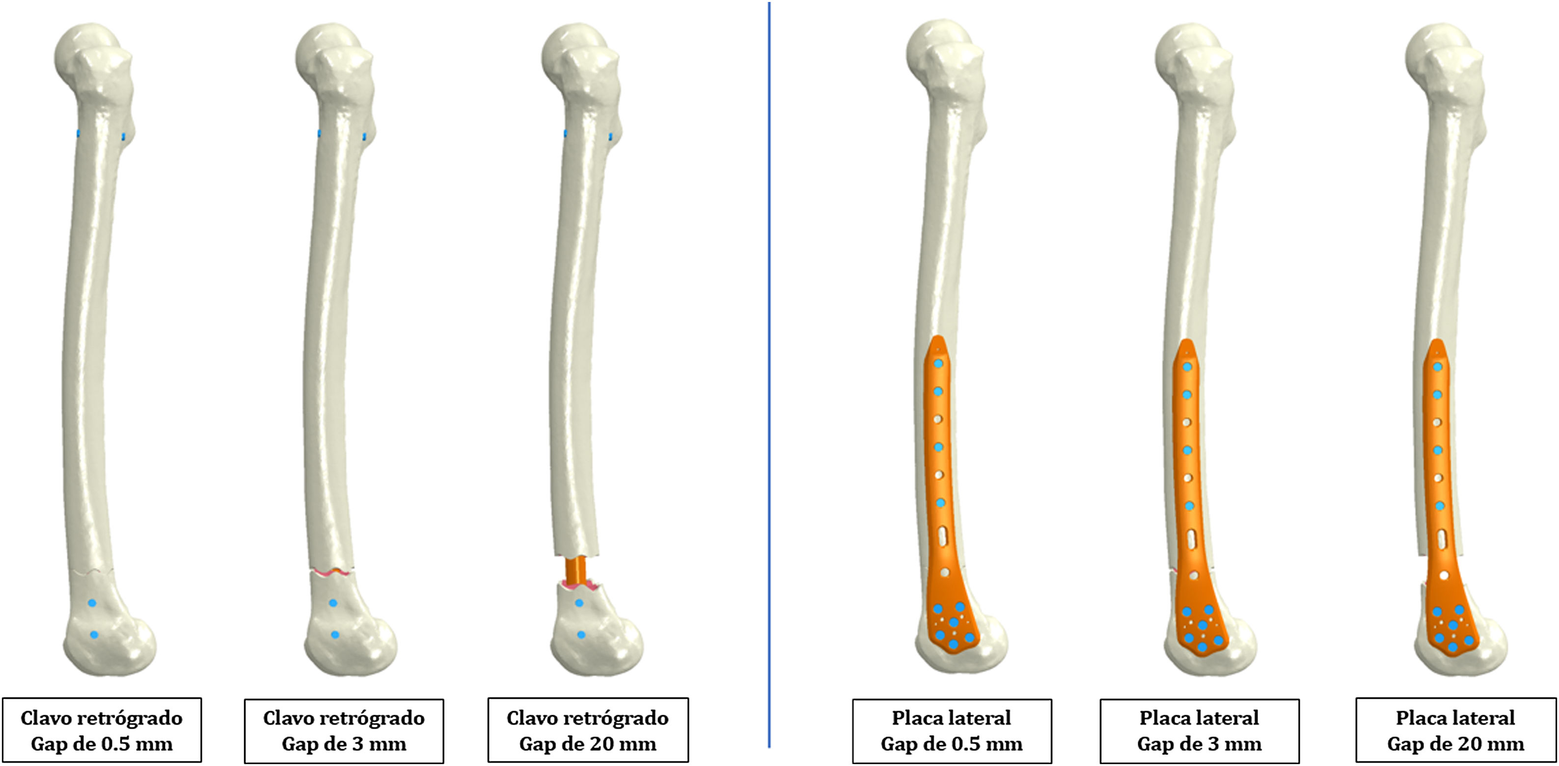 Estudio comparativo clínico y biomecánico de distintos tipos de ...