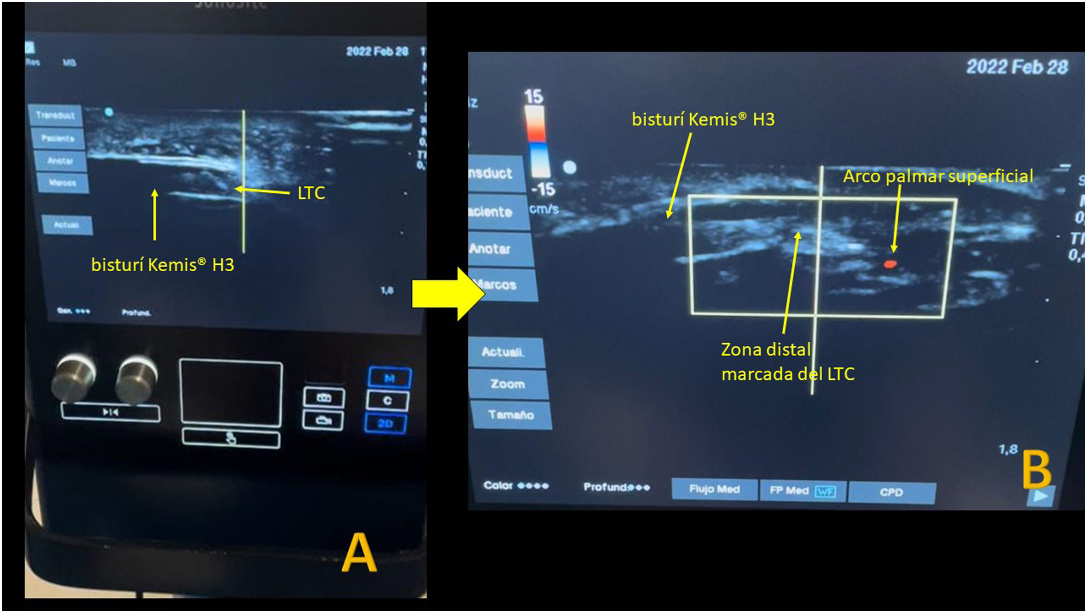 Percutaneous ultrasound-guided section of the transverse carpal ...